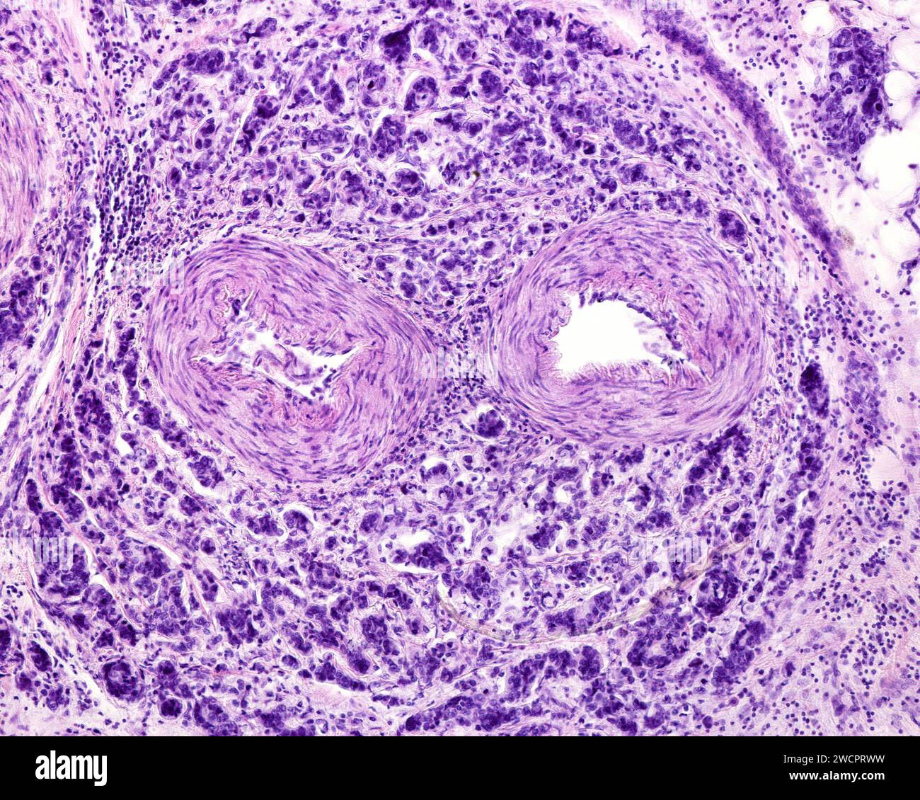 Prostate cancer, light micrograph Stock Photo - Alamy