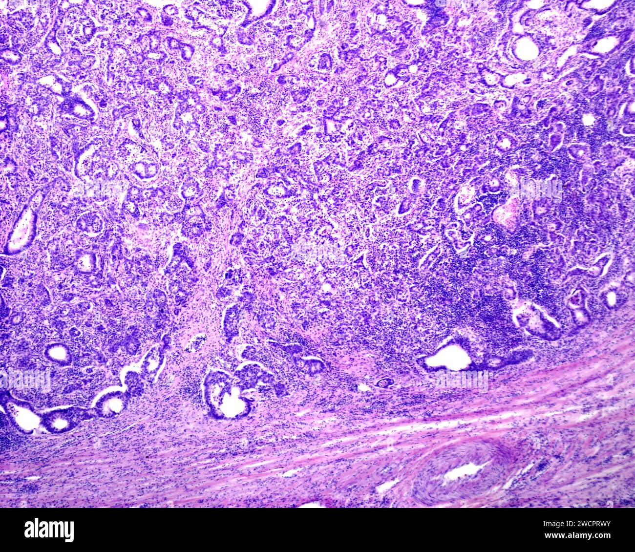 Prostate cancer, light micrograph Stock Photo - Alamy