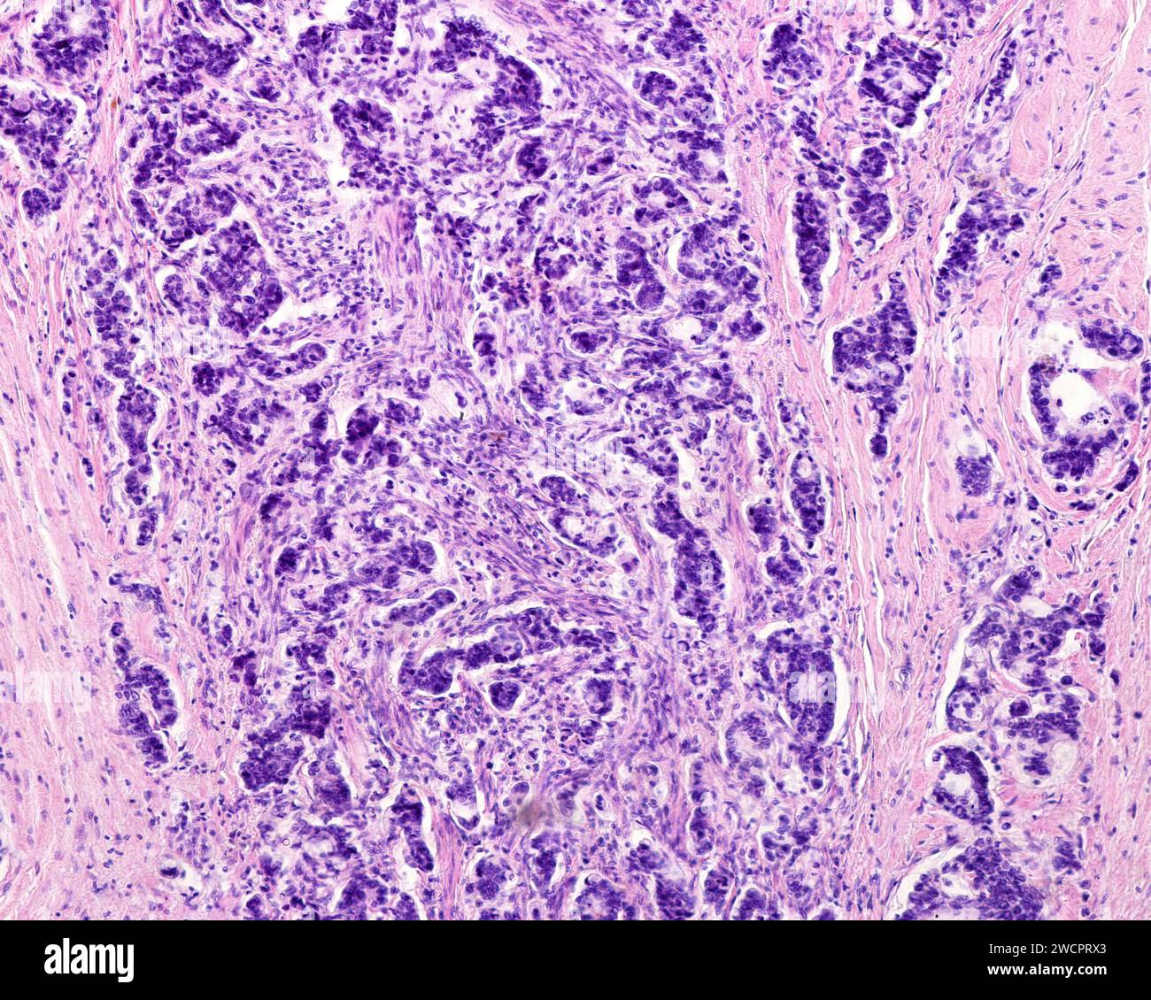 Prostate cancer, light micrograph Stock Photo - Alamy