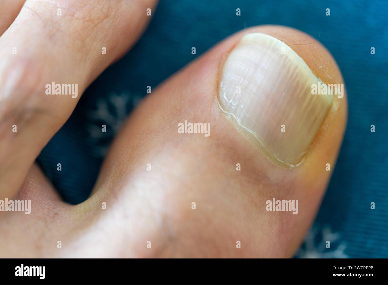Cut toe hi-res stock photography and images - Alamy