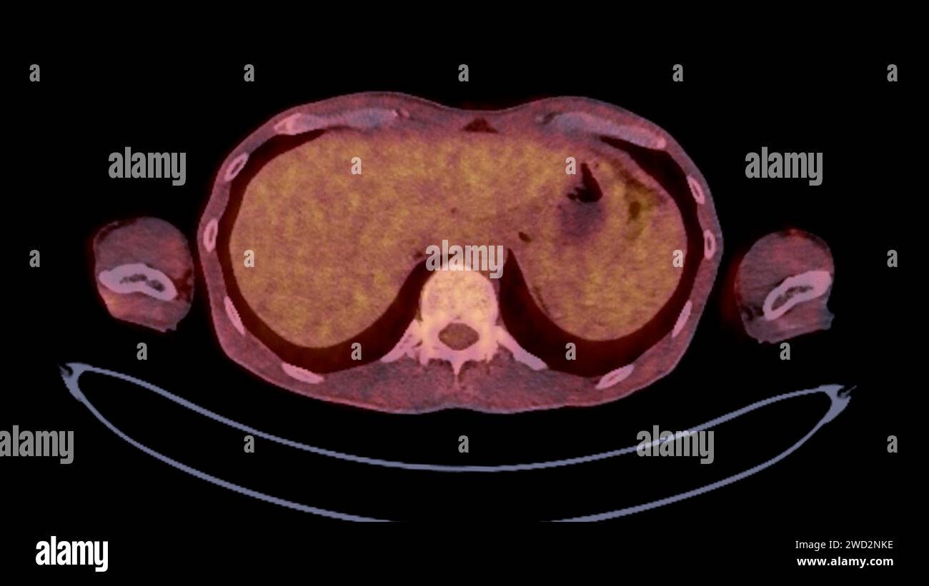 A PET-CT scan image is a diagnostic visualization combining Positron ...