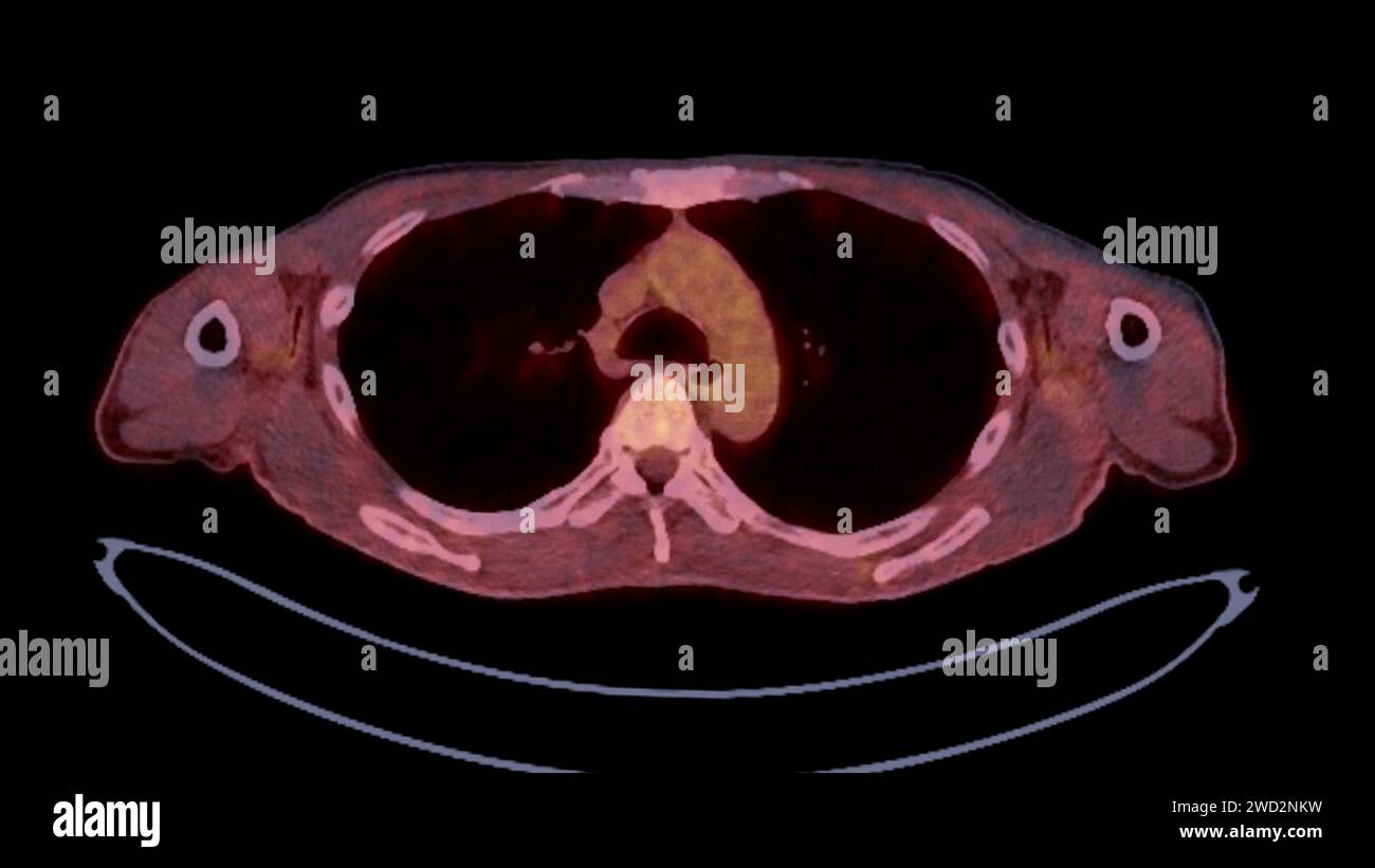 A PET-CT scan image is a diagnostic visualization combining Positron ...