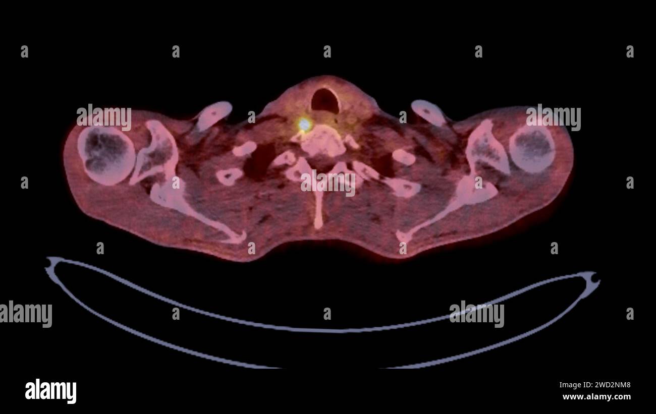 A PET-CT scan image is a diagnostic visualization combining Positron ...