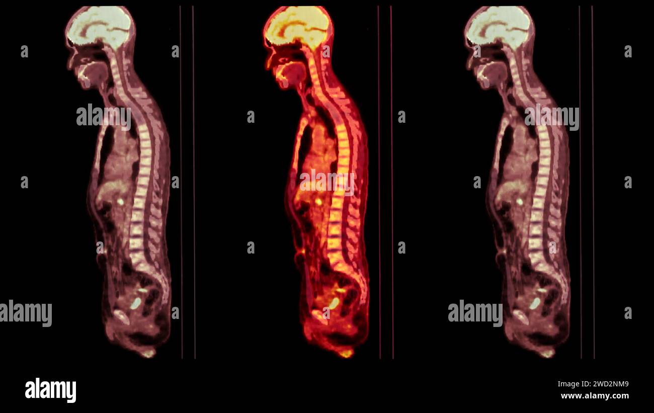 A PET-CT scan image is a diagnostic visualization combining Positron ...