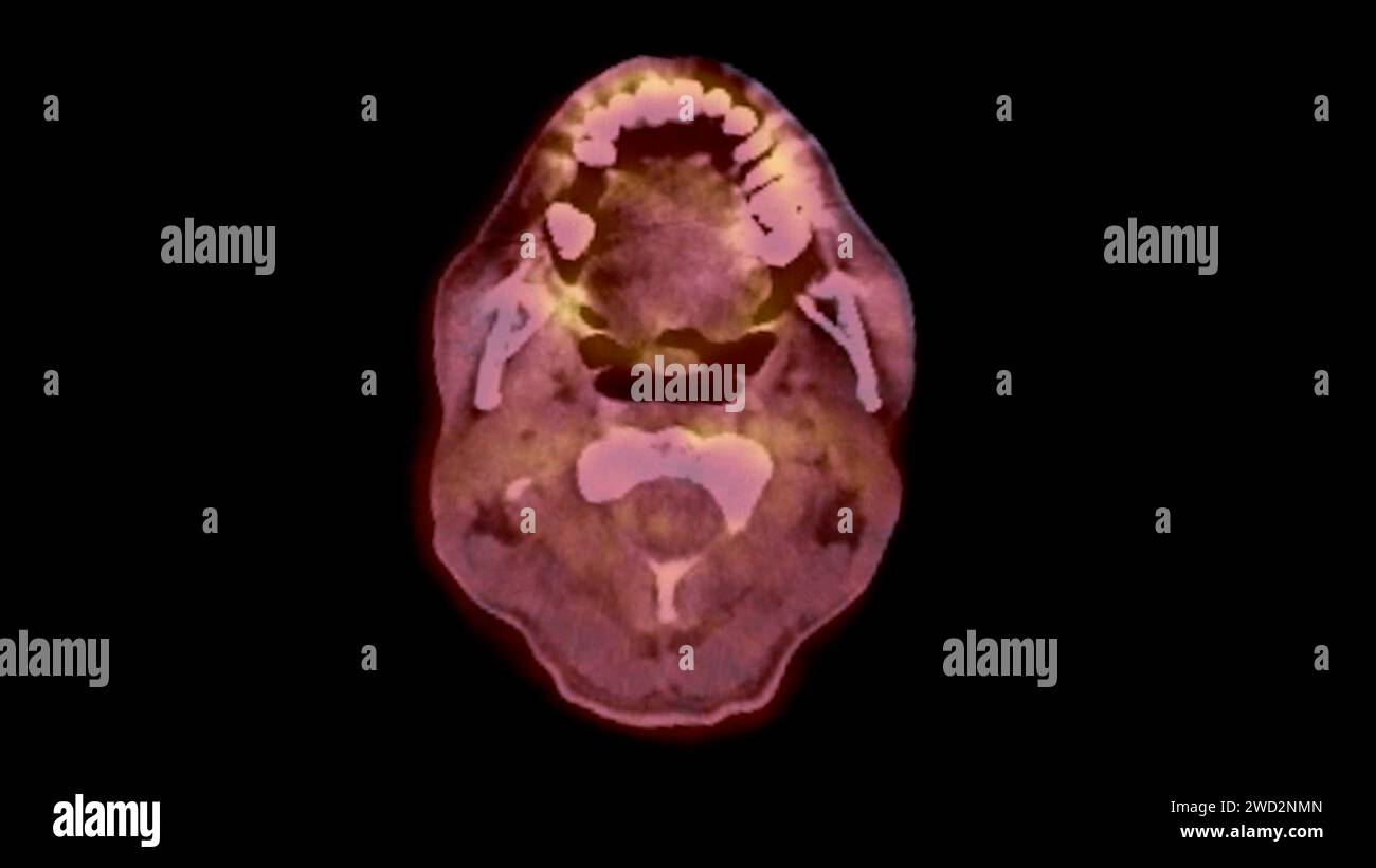 A PET-CT scan image is a diagnostic visualization combining Positron ...