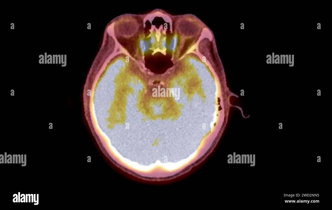 A PET-CT scan image is a diagnostic visualization combining Positron ...