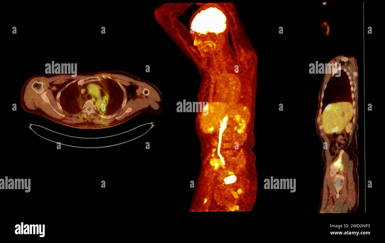 A PET-CT scan image is a diagnostic visualization combining Positron ...
