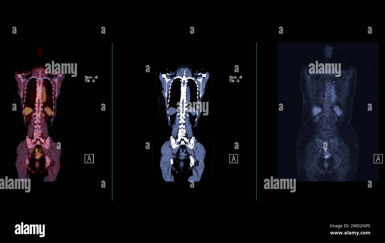 A PET-CT scan image is a diagnostic visualization combining Positron ...