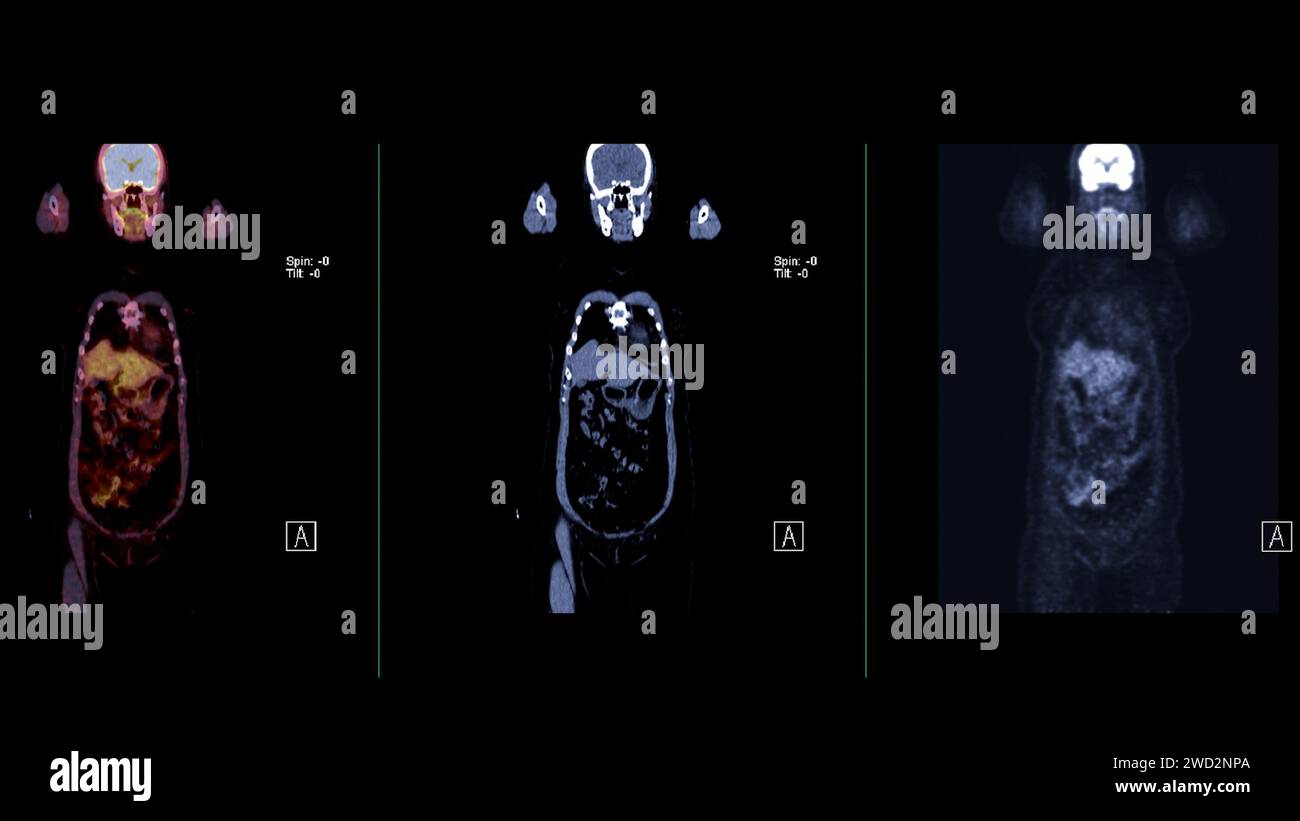 A PET-CT scan image is a diagnostic visualization combining Positron ...