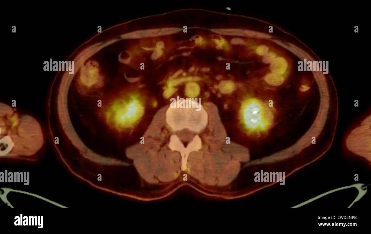 A PET-CT scan image is a diagnostic visualization combining Positron ...