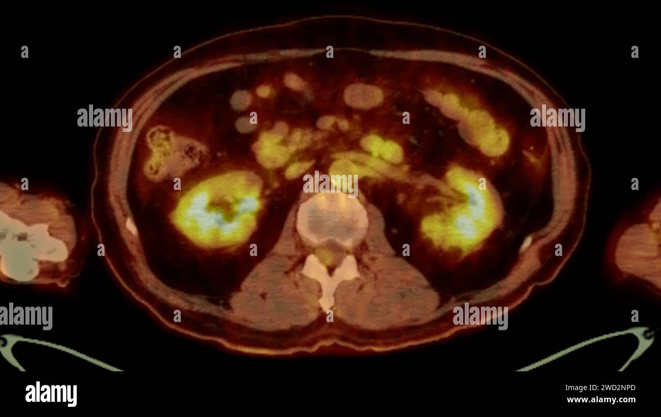 A PET-CT scan image is a diagnostic visualization combining Positron ...