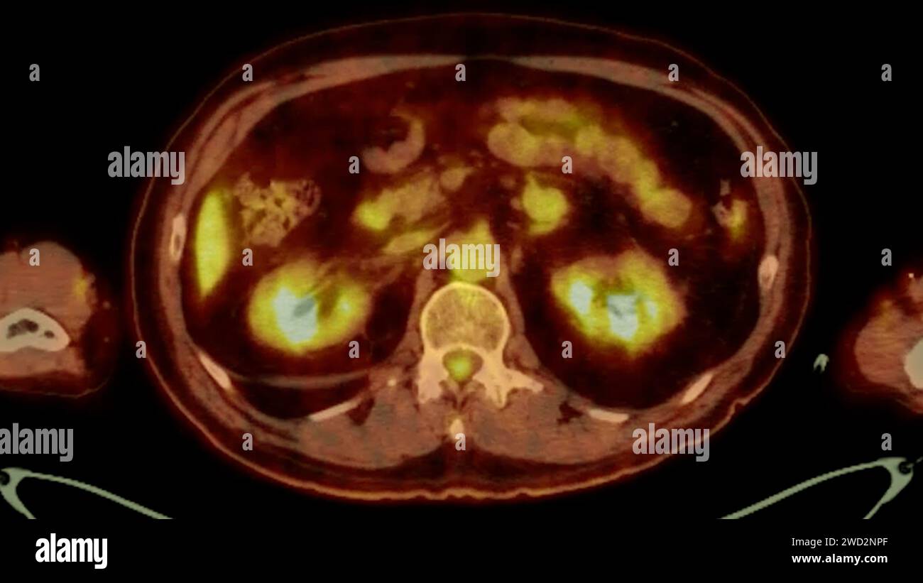 A PET-CT scan image is a diagnostic visualization combining Positron ...