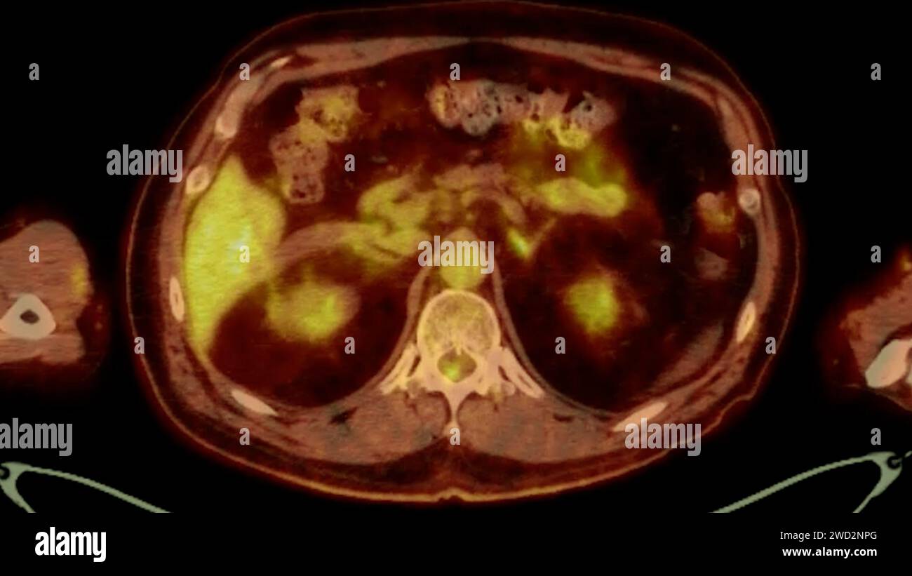 A PET-CT scan image is a diagnostic visualization combining Positron ...