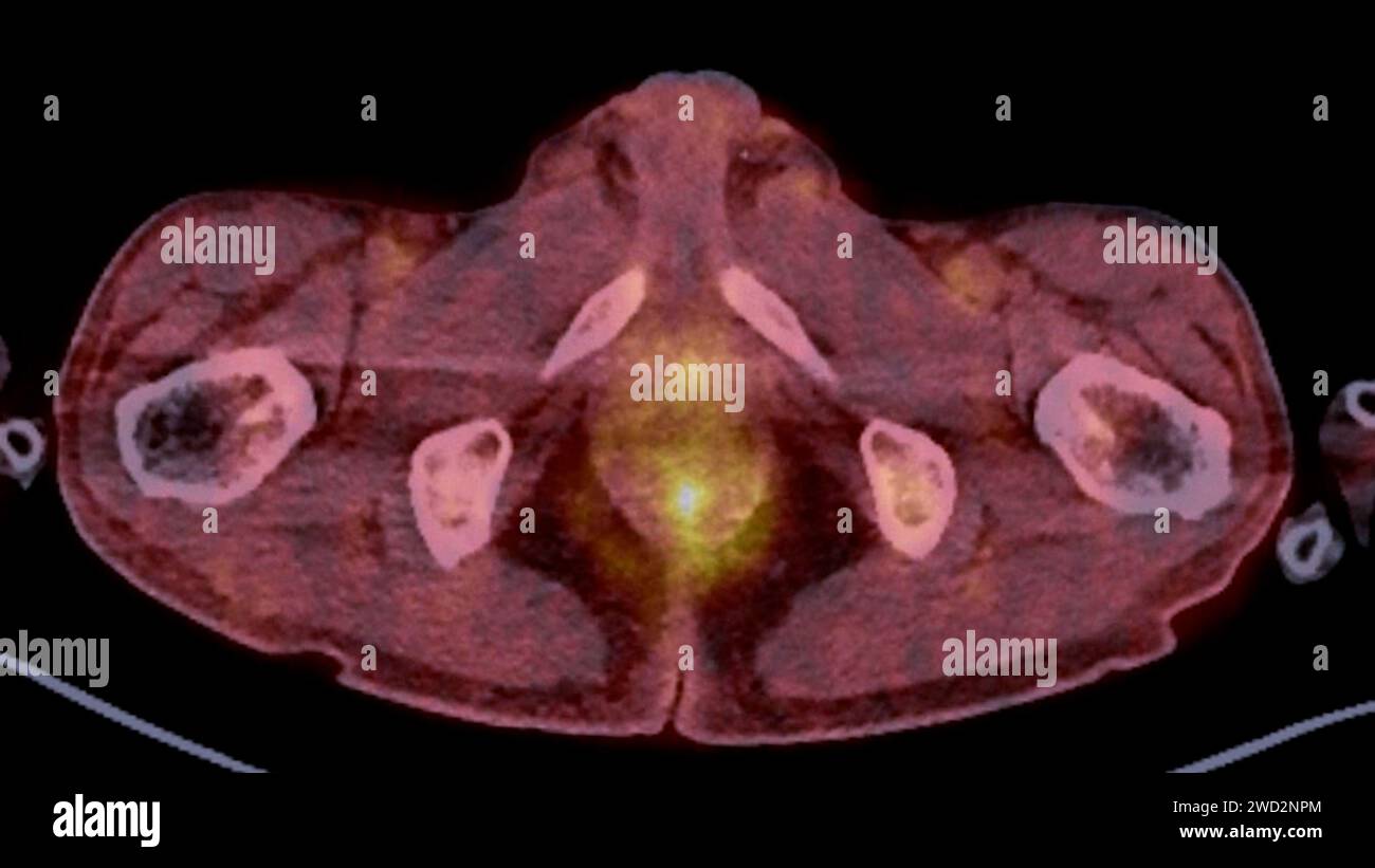 A PET-CT scan image is a diagnostic visualization combining Positron ...
