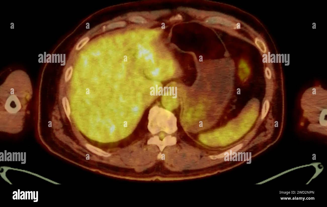 A PET-CT scan image is a diagnostic visualization combining Positron ...