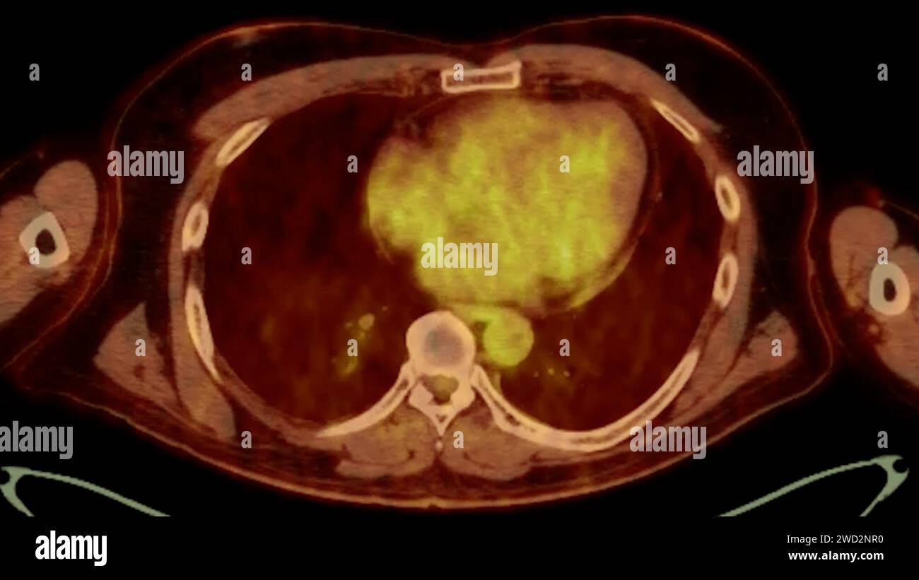 A PET-CT scan image is a diagnostic visualization combining Positron ...
