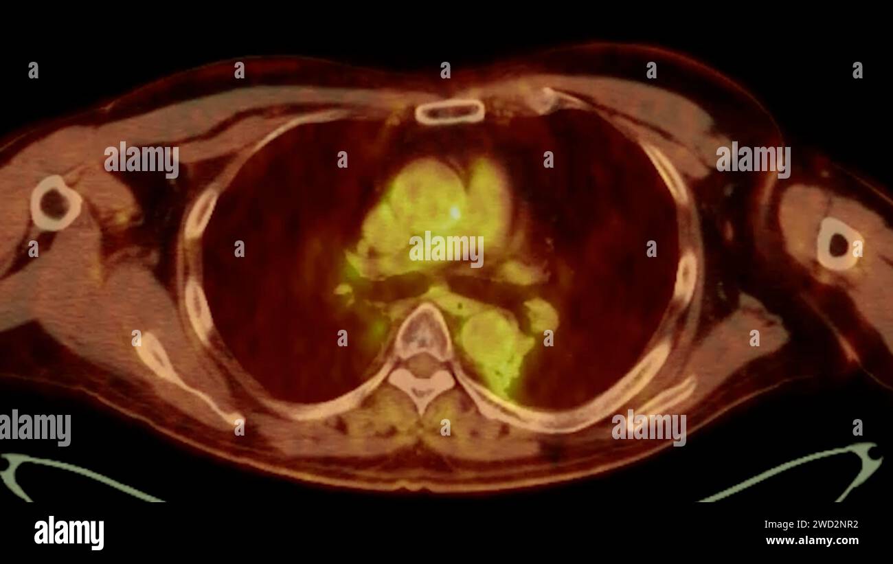 A PET-CT scan image is a diagnostic visualization combining Positron ...