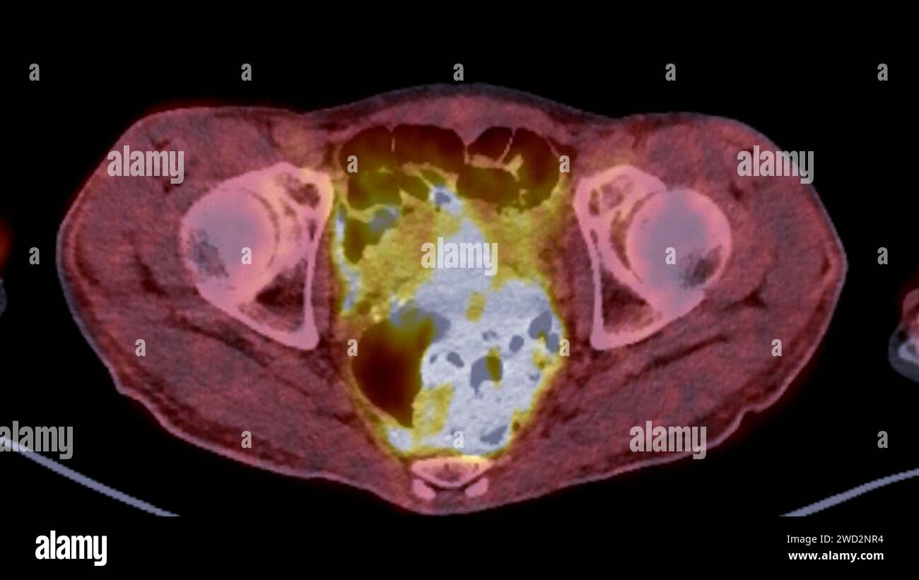 A PET-CT scan image is a diagnostic visualization combining Positron ...