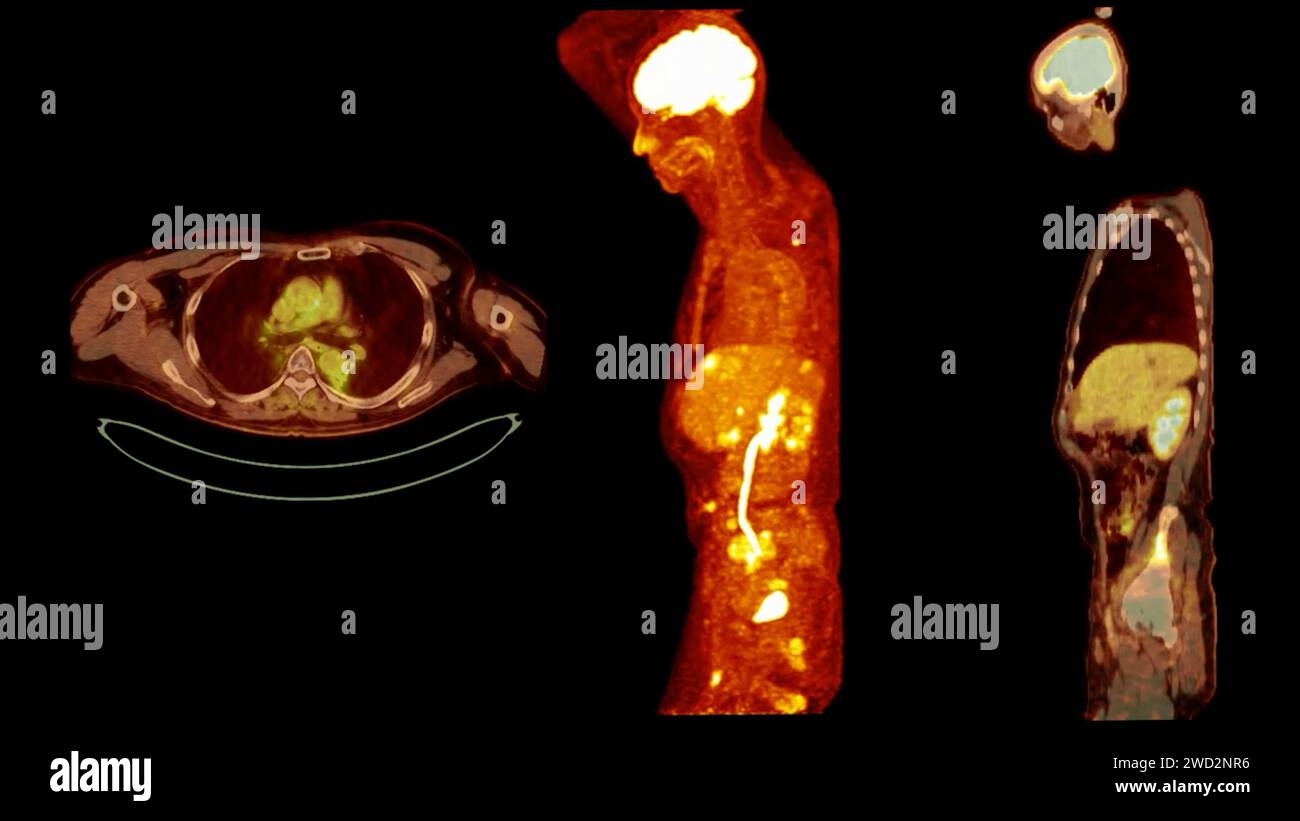 A PET-CT scan image is a diagnostic visualization combining Positron ...
