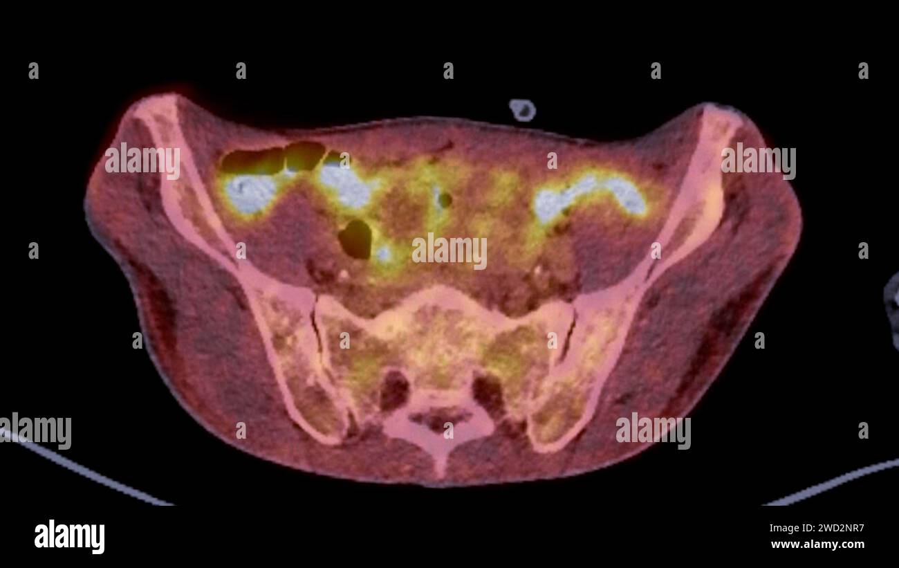 A PET-CT scan image is a diagnostic visualization combining Positron ...