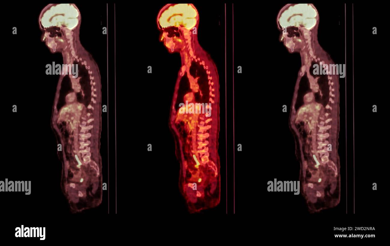 A PET-CT scan image is a diagnostic visualization combining Positron ...