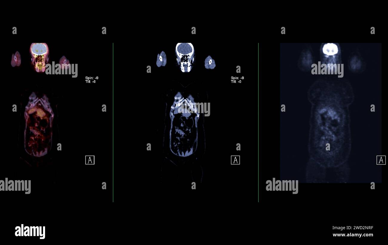 A PET-CT scan image is a diagnostic visualization combining Positron ...