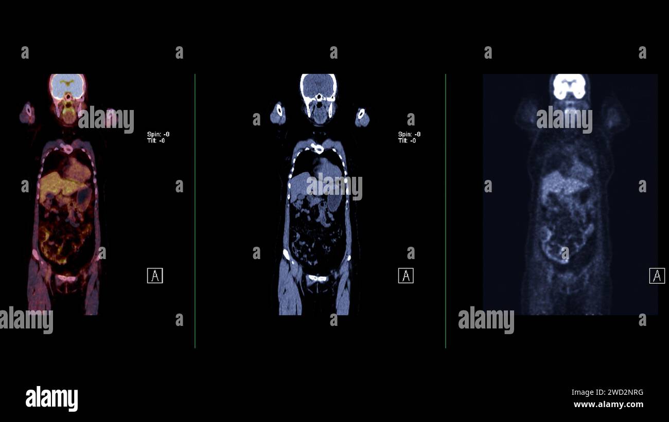 A PET-CT scan image is a diagnostic visualization combining Positron ...