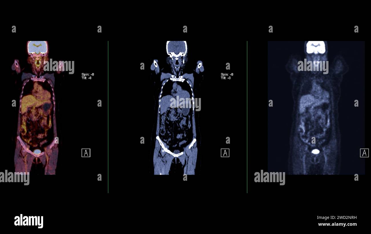 A PET-CT scan image is a diagnostic visualization combining Positron ...