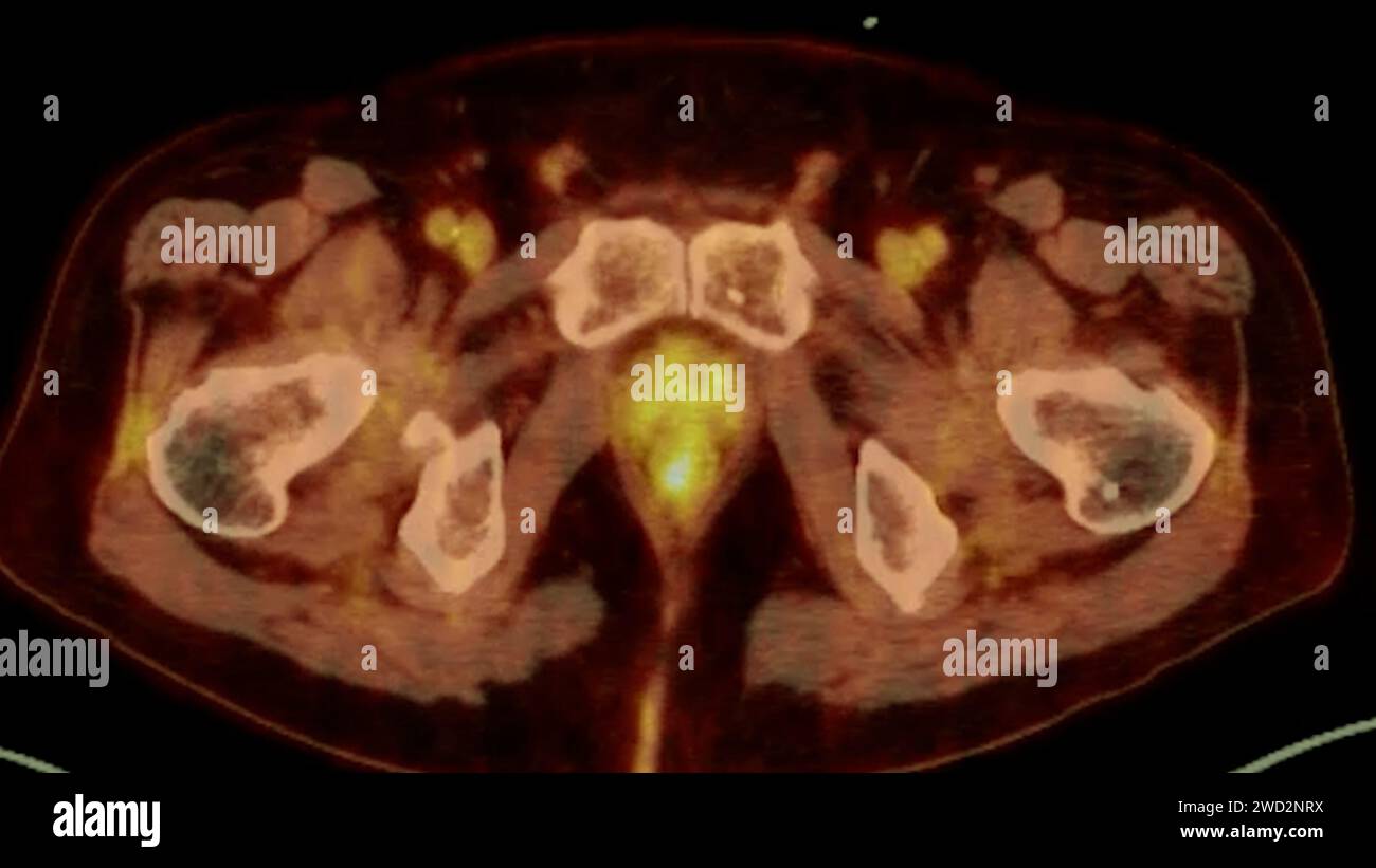 A PET-CT scan image is a diagnostic visualization combining Positron ...