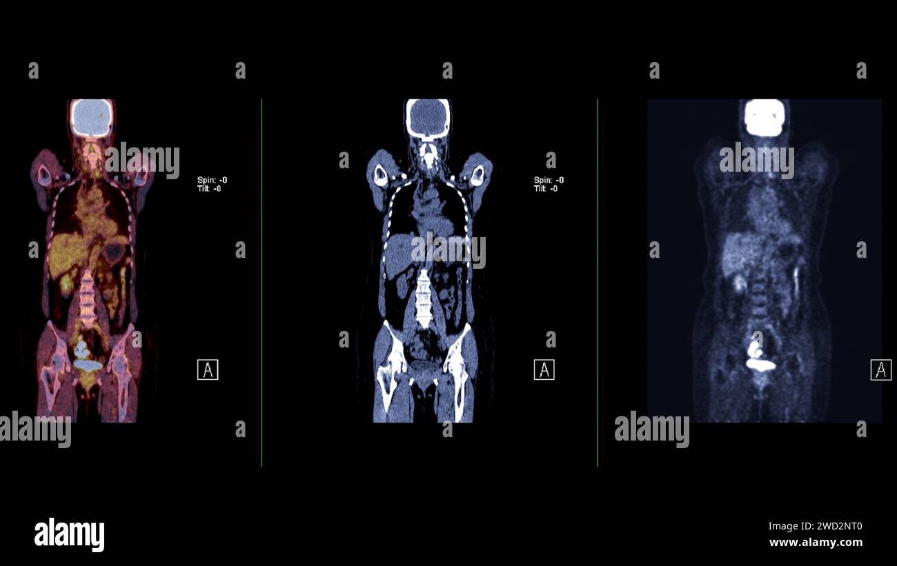 A PET-CT scan image is a diagnostic visualization combining Positron ...