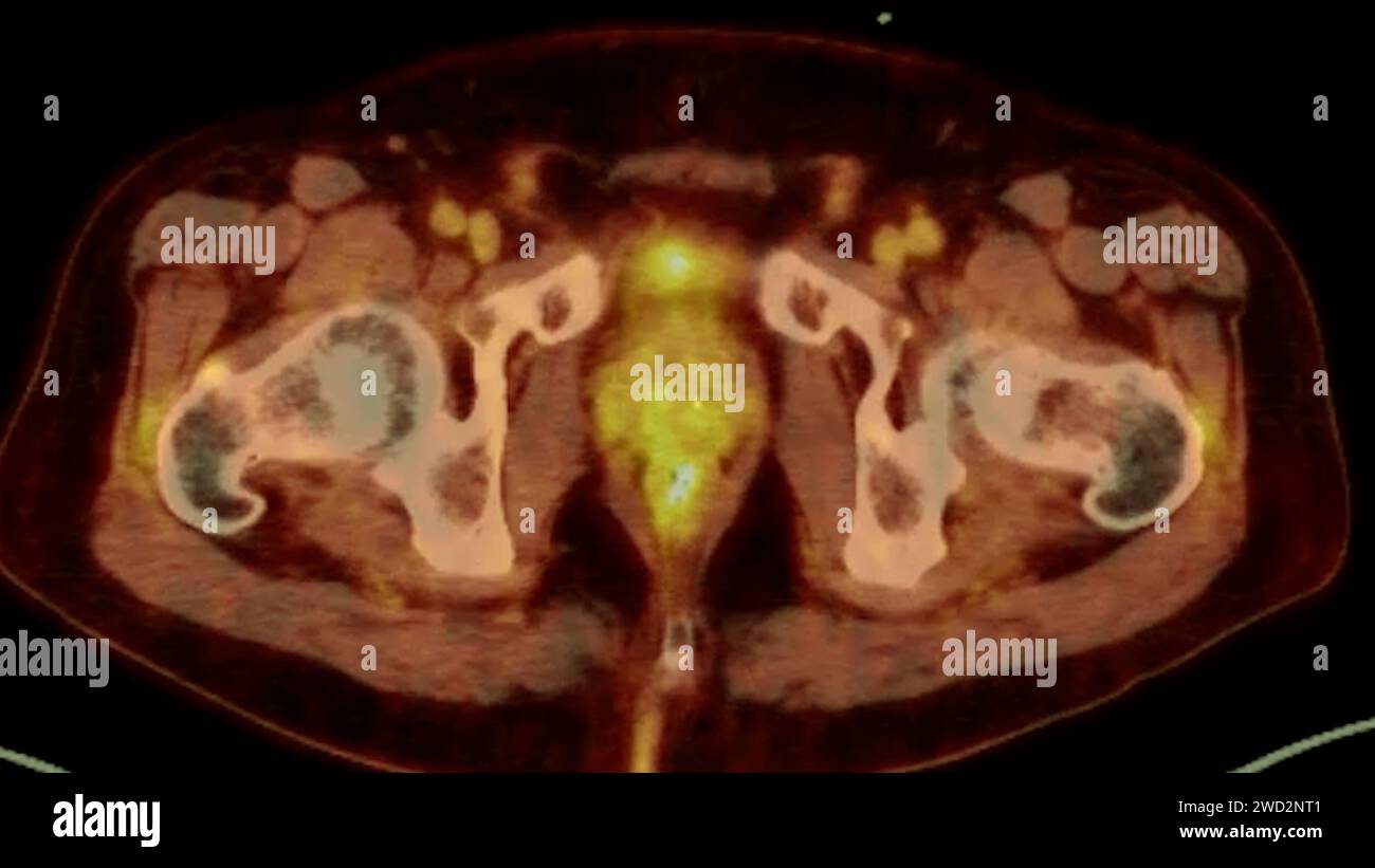 A PET-CT scan image is a diagnostic visualization combining Positron ...