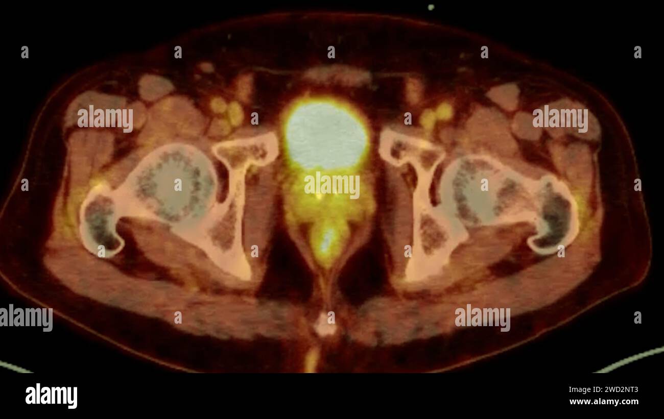 A PET-CT scan image is a diagnostic visualization combining Positron ...