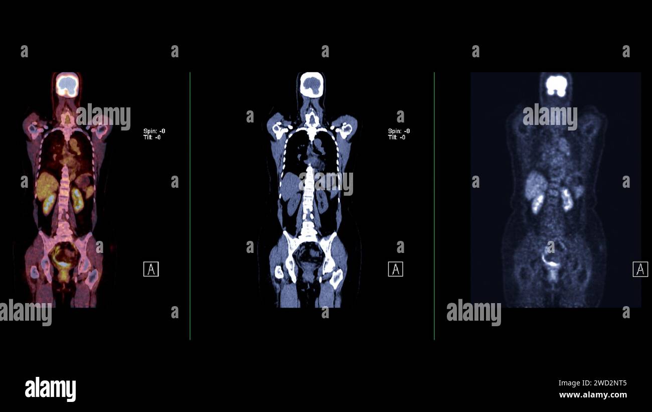 A PET-CT scan image is a diagnostic visualization combining Positron ...