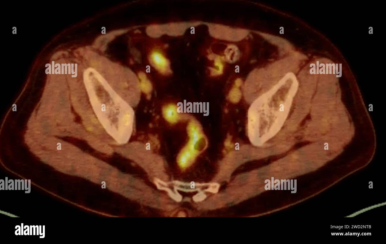 A PET-CT scan image is a diagnostic visualization combining Positron ...