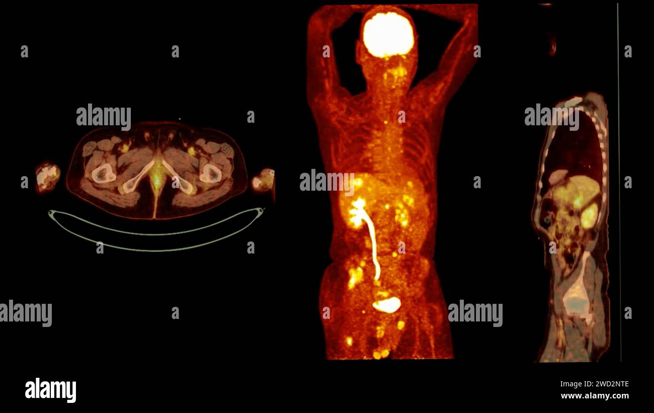A PET-CT scan image is a diagnostic visualization combining Positron ...