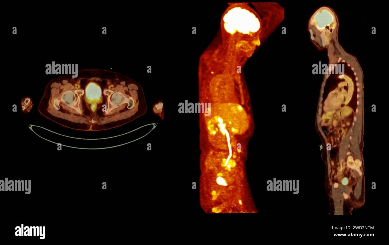 A PET-CT scan image is a diagnostic visualization combining Positron ...