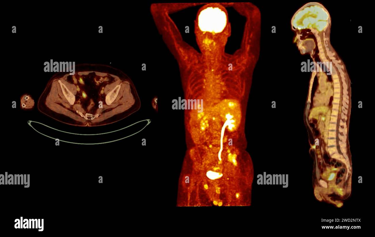 A PET-CT scan image is a diagnostic visualization combining Positron ...