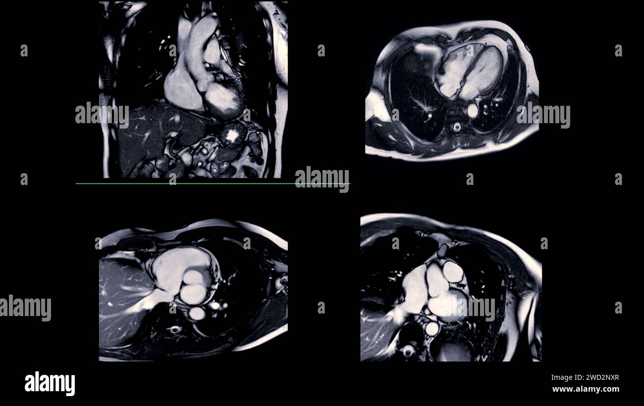 Cardiac MRI images are instrumental in assessing cardiac health ...