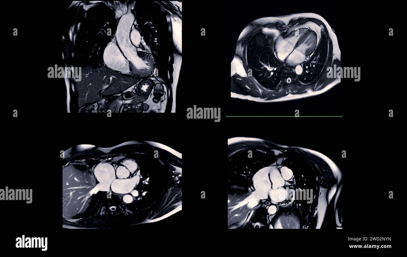 Cardiac MRI images are instrumental in assessing cardiac health ...