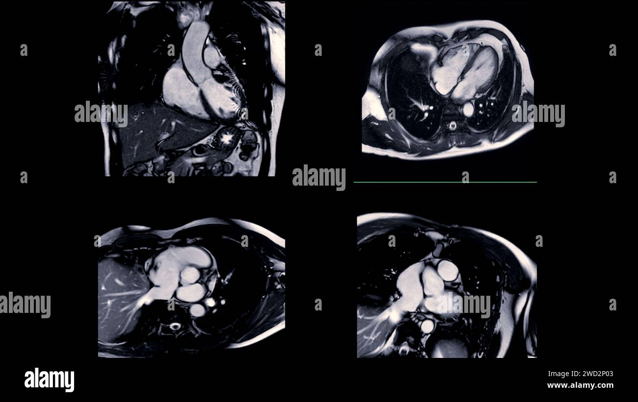 Cardiac MRI images are instrumental in assessing cardiac health ...