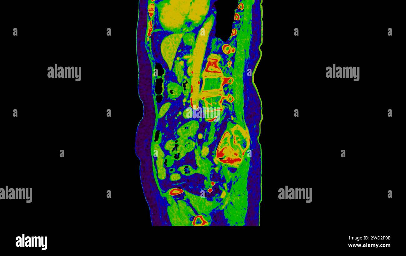 CT scan of Abdomen sagittal view with injection contrast media with ...