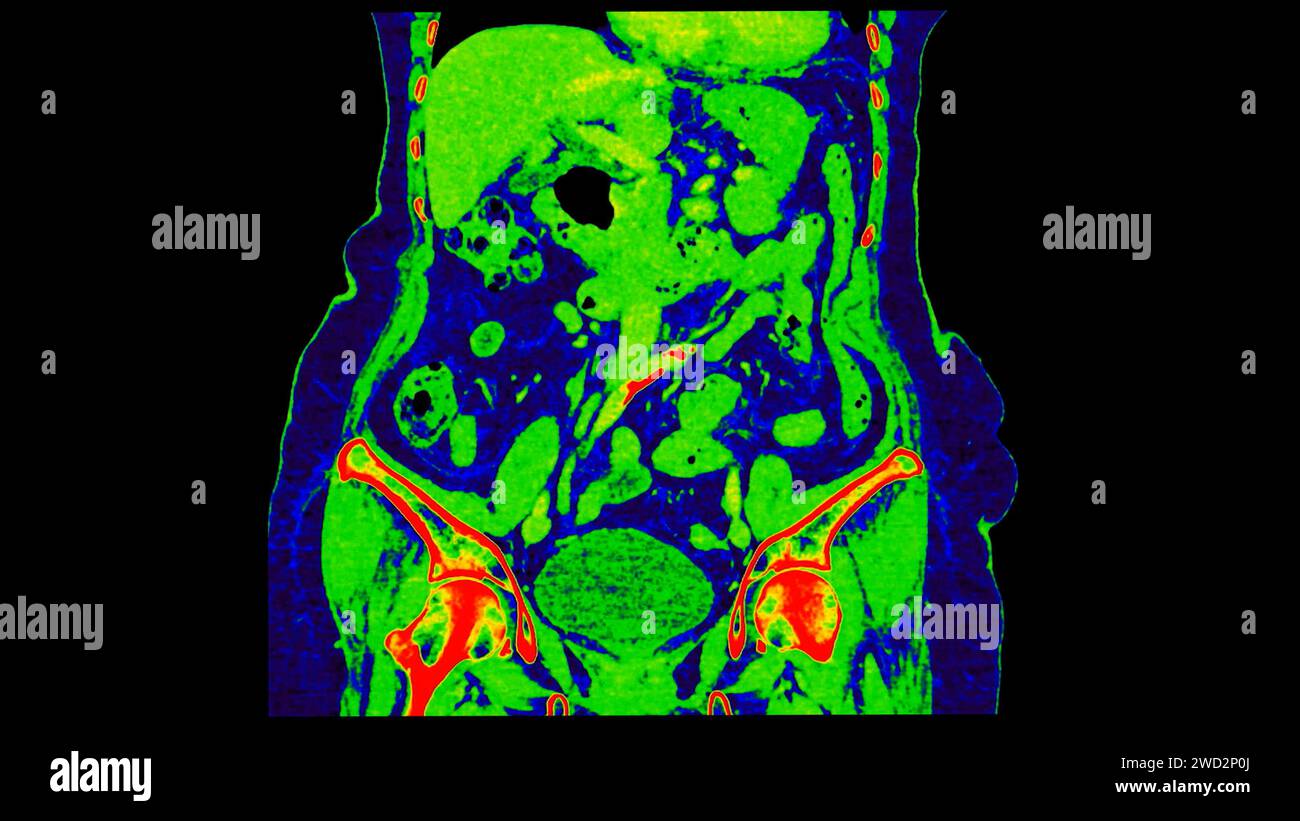 CT scan of Abdomen coronal view with injection contrast media with ...