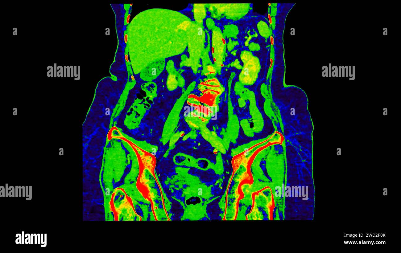 CT scan of Abdomen coronal view with injection contrast media with ...