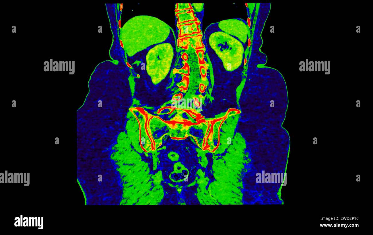 CT scan of Abdomen coronal view with injection contrast media with ...
