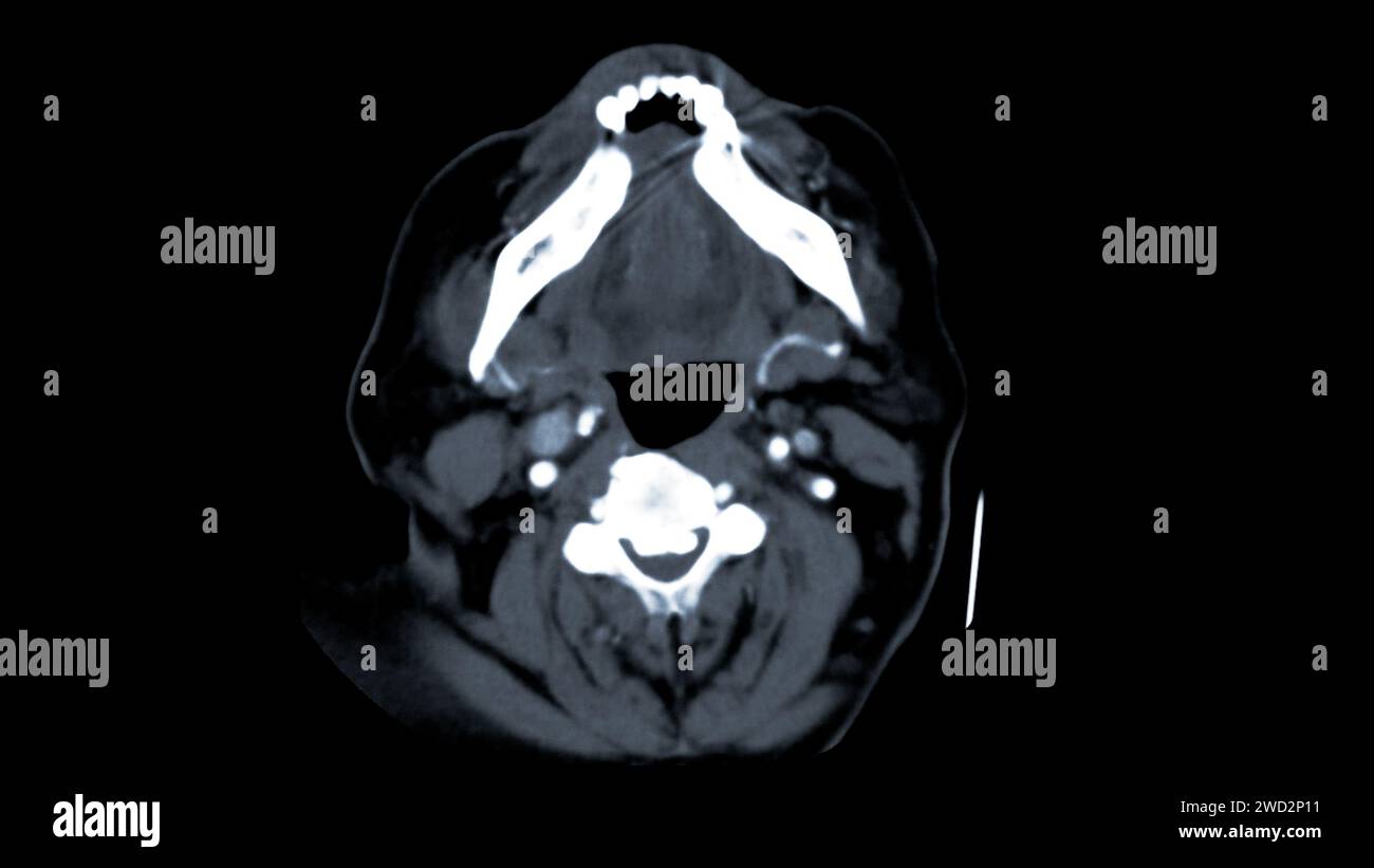 CT scan of the brain Axial view for diagnosis brain tumor,stroke ...