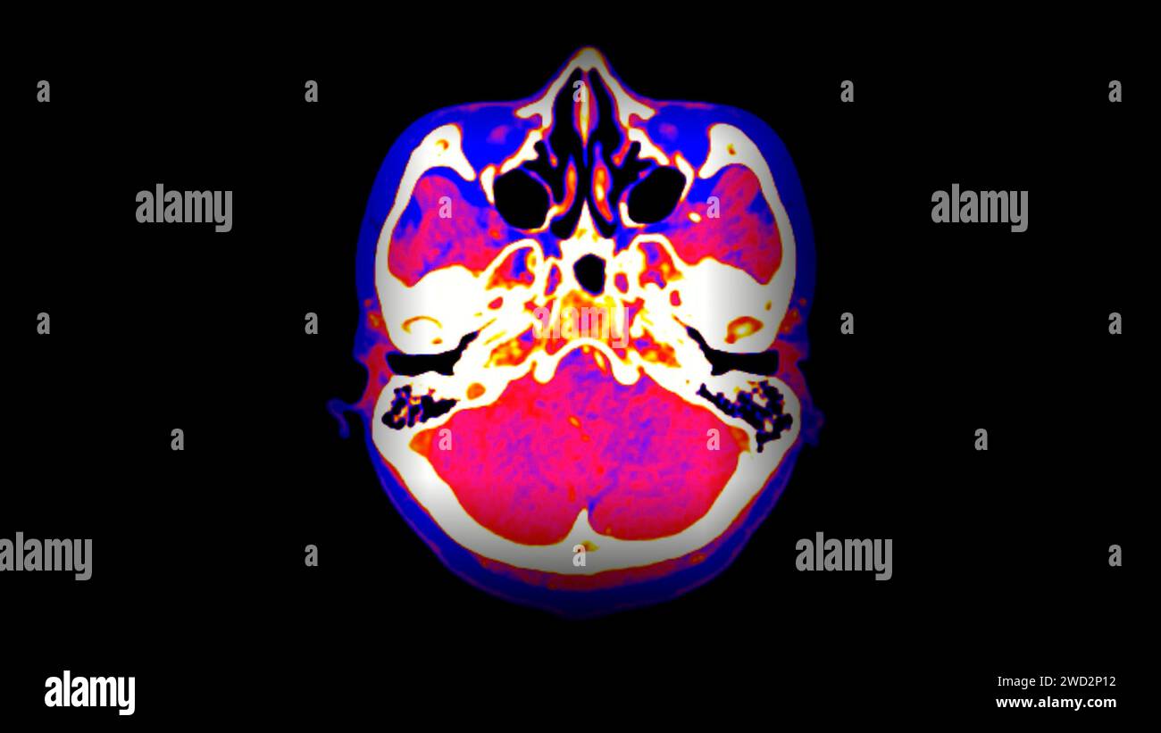 CT Brain Perfusion or CT scan image of the brain axial view Stock Photo ...