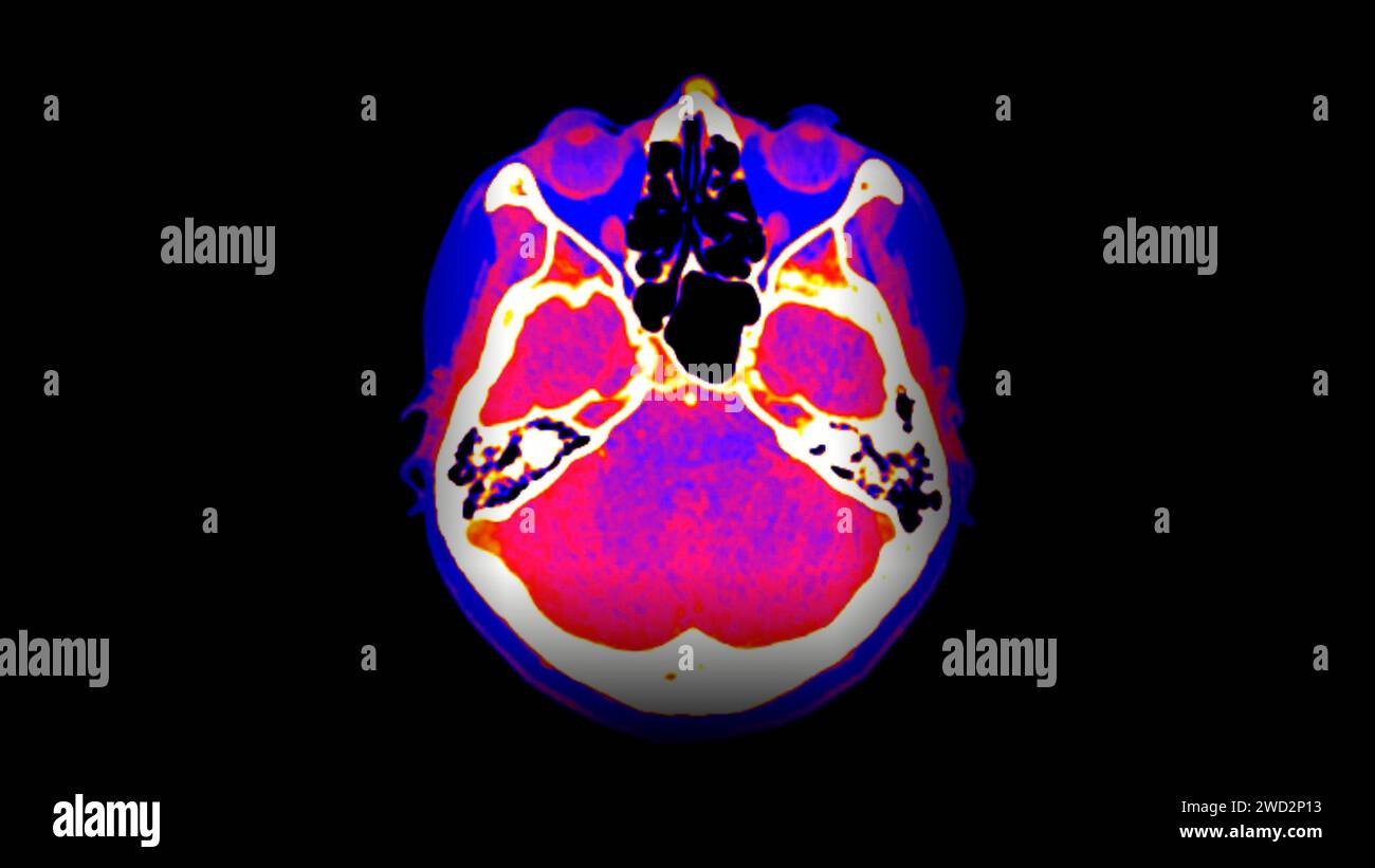 CT Brain Perfusion or CT scan image of the brain axial view Stock Photo ...