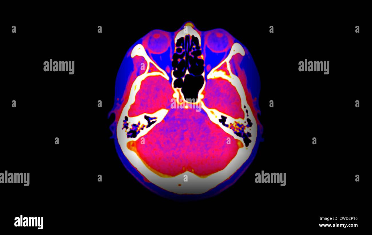 CT Brain Perfusion or CT scan image of the brain axial view Stock Photo ...