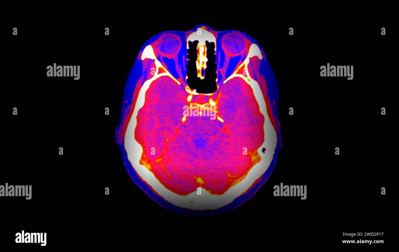 CT Brain Perfusion or CT scan image of the brain axial view Stock Photo ...