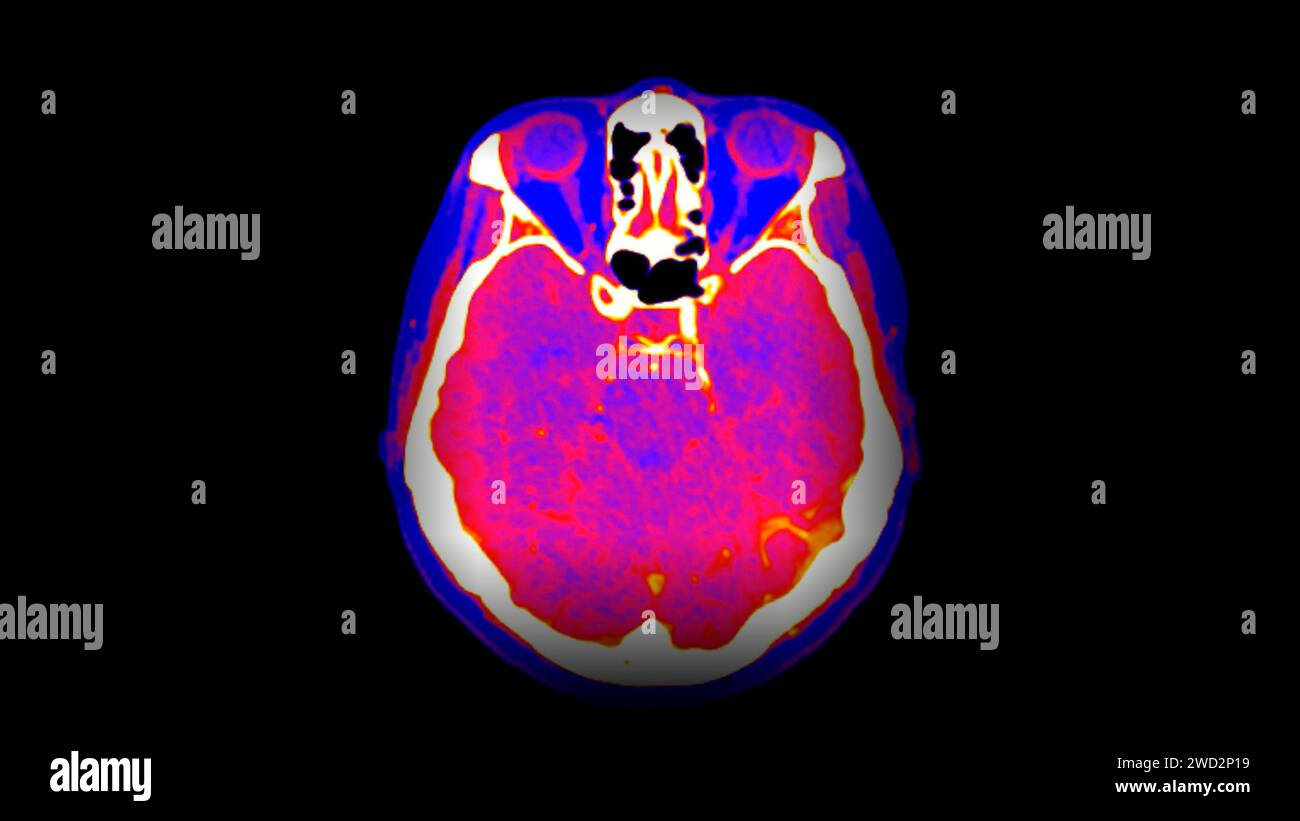 CT Brain Perfusion or CT scan image of the brain axial view Stock Photo ...